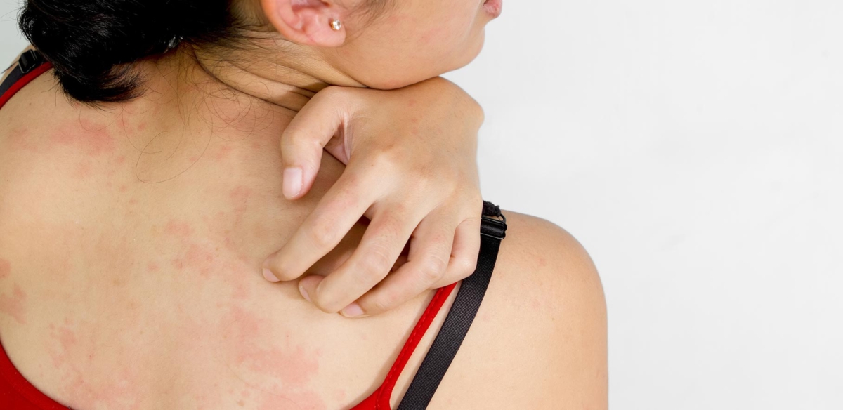 What is the best way for your body to process an overload of histamine ...